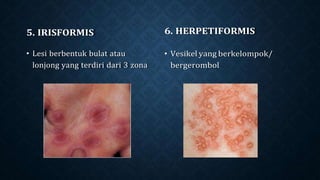 389323818-Susunan-kelainan-kulit.docx