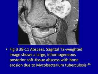 38 benign soft tissue masses on magnetic resonance imaging | PPT