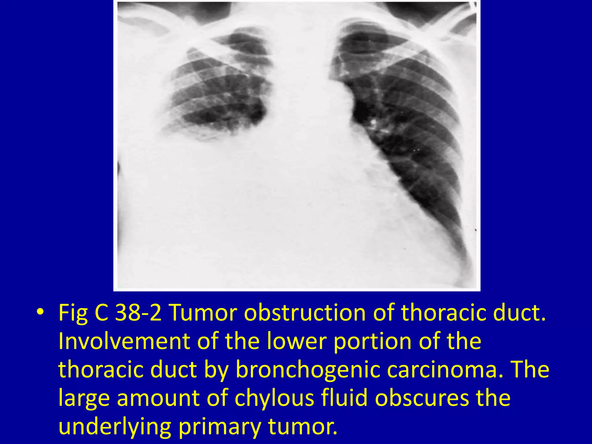 38 chylothorax | PPTX