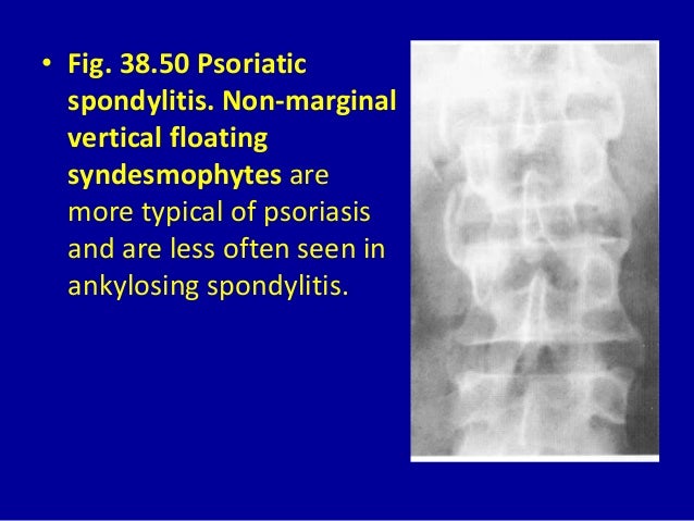 Non Marginal Syndesmophytes Ankylosing Spondylitis Imaging Signs Part