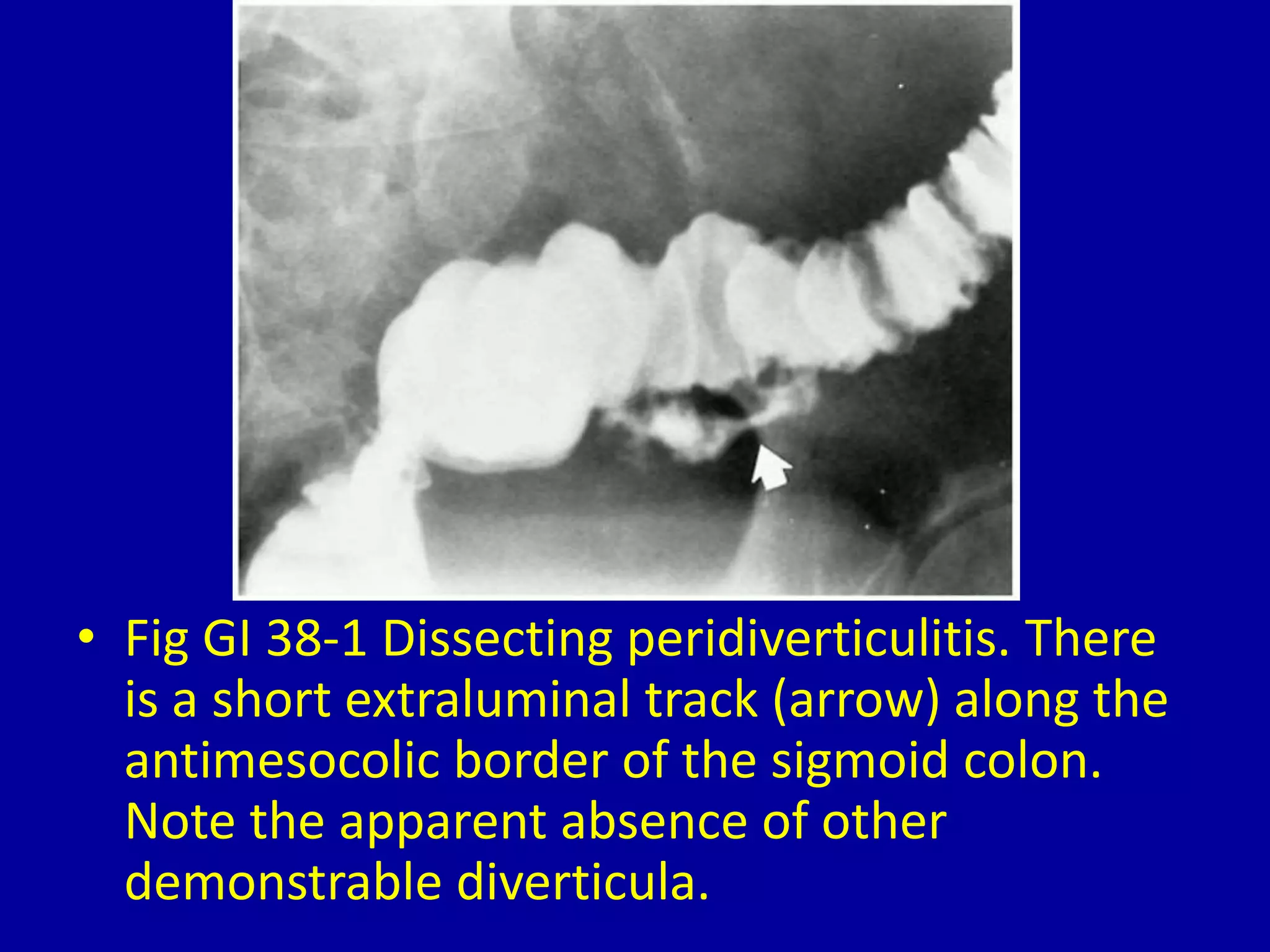 38 double tracking in the colon | PPTX
