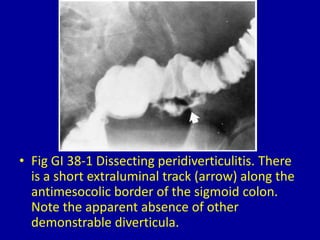 38 double tracking in the colon | PPTX | Digestive Disorders | Diseases ...