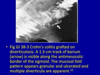 38 double tracking in the colon | PPTX | Digestive Disorders | Diseases ...