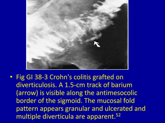 38 double tracking in the colon | PPTX | Digestive Disorders | Diseases ...