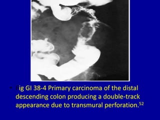 38 double tracking in the colon | PPTX | Digestive Disorders | Diseases ...