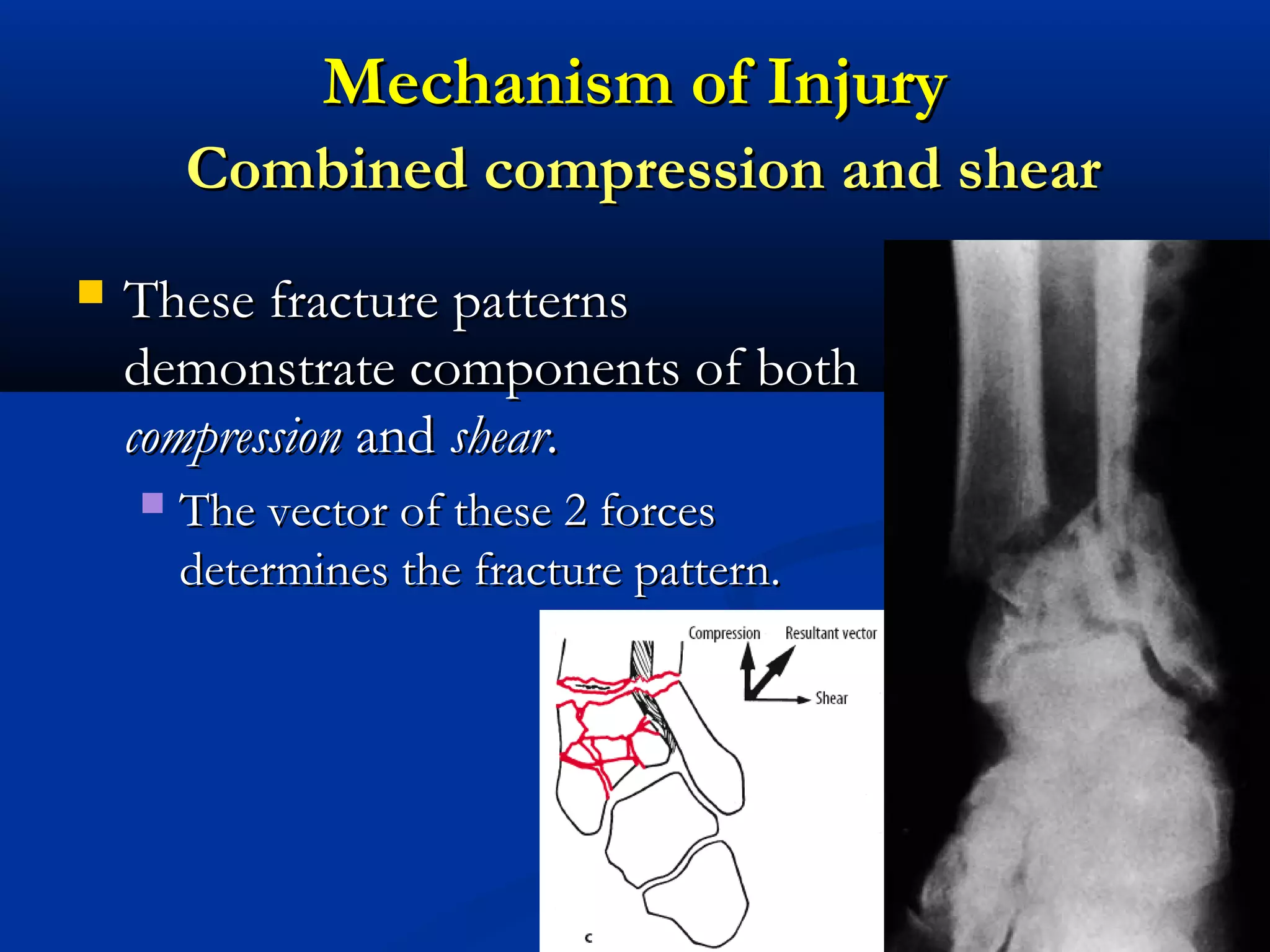 39. tibial plafond (pilon) fractures | PPT