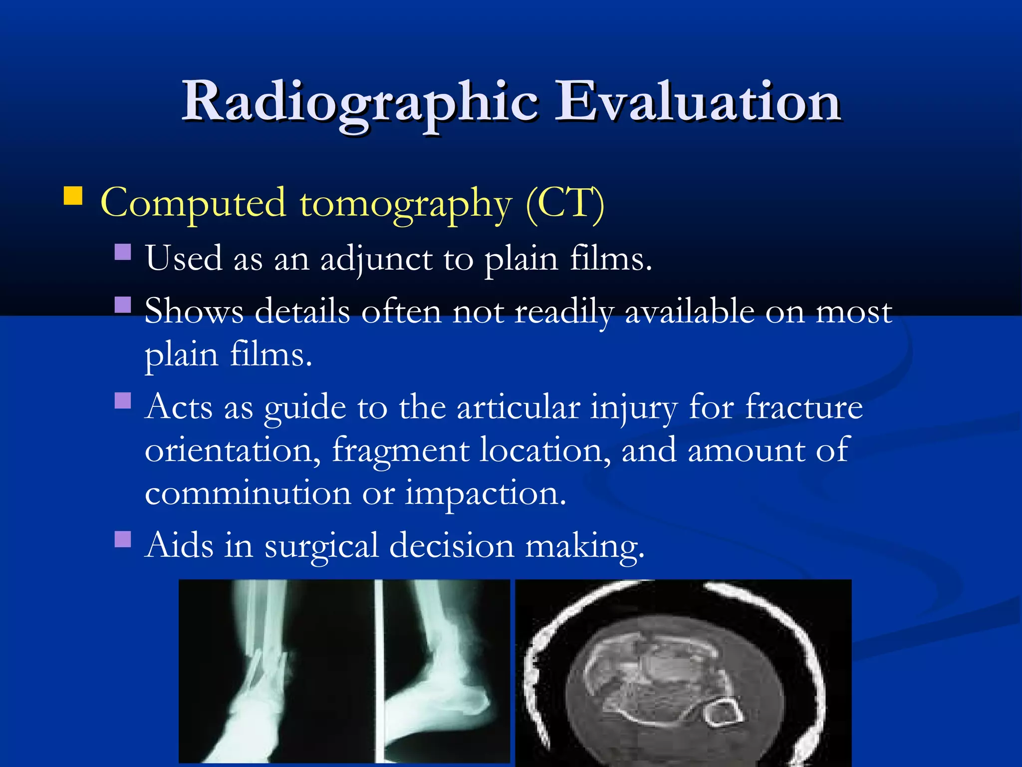39. tibial plafond (pilon) fractures | PPT