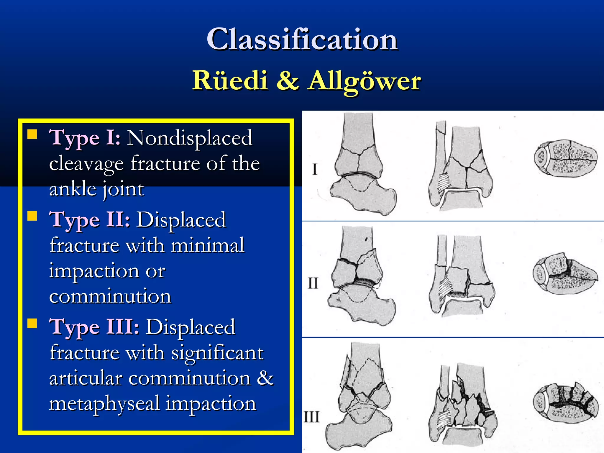 39. tibial plafond (pilon) fractures | PPT