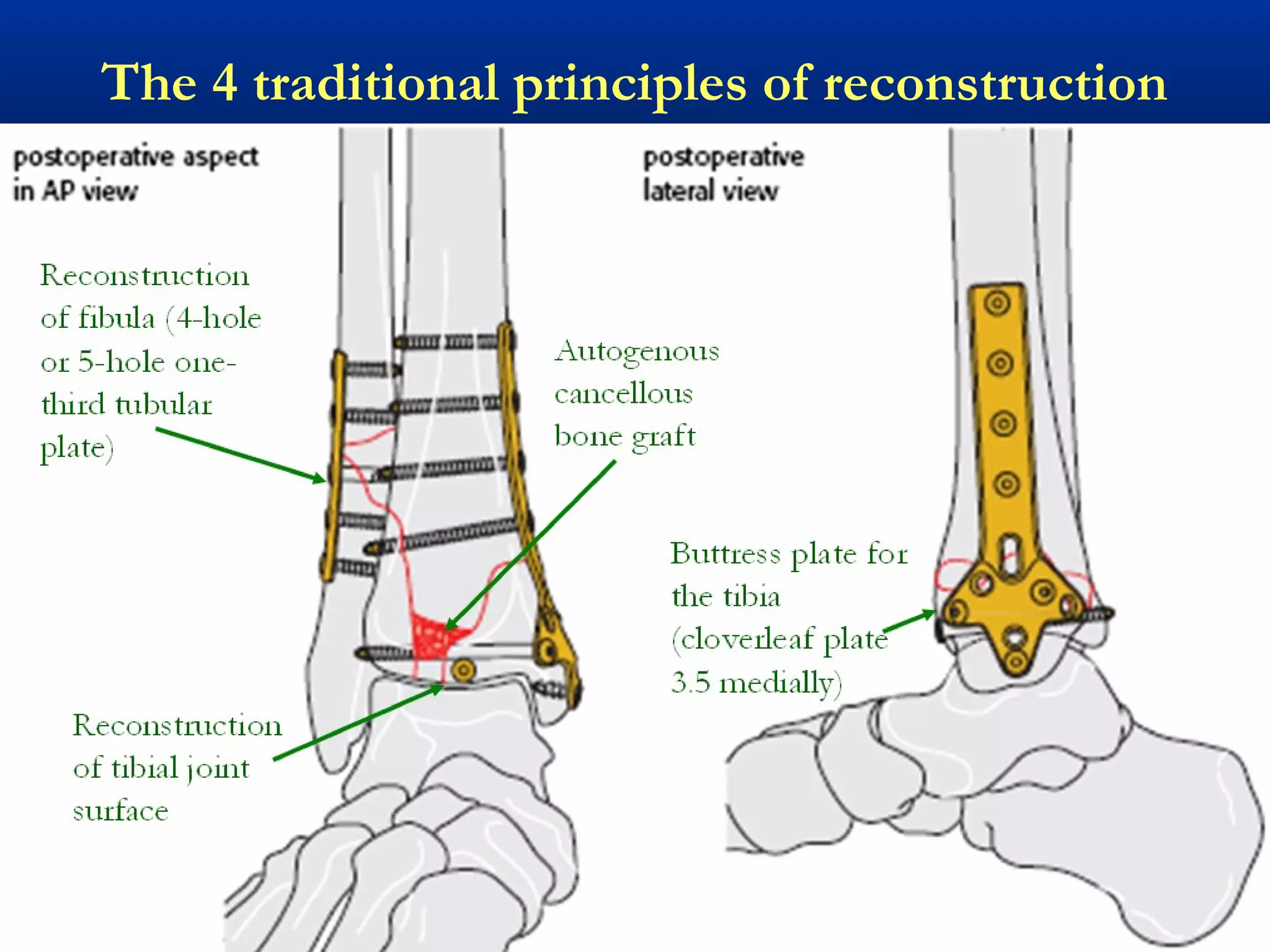 39. tibial plafond (pilon) fractures | PPT