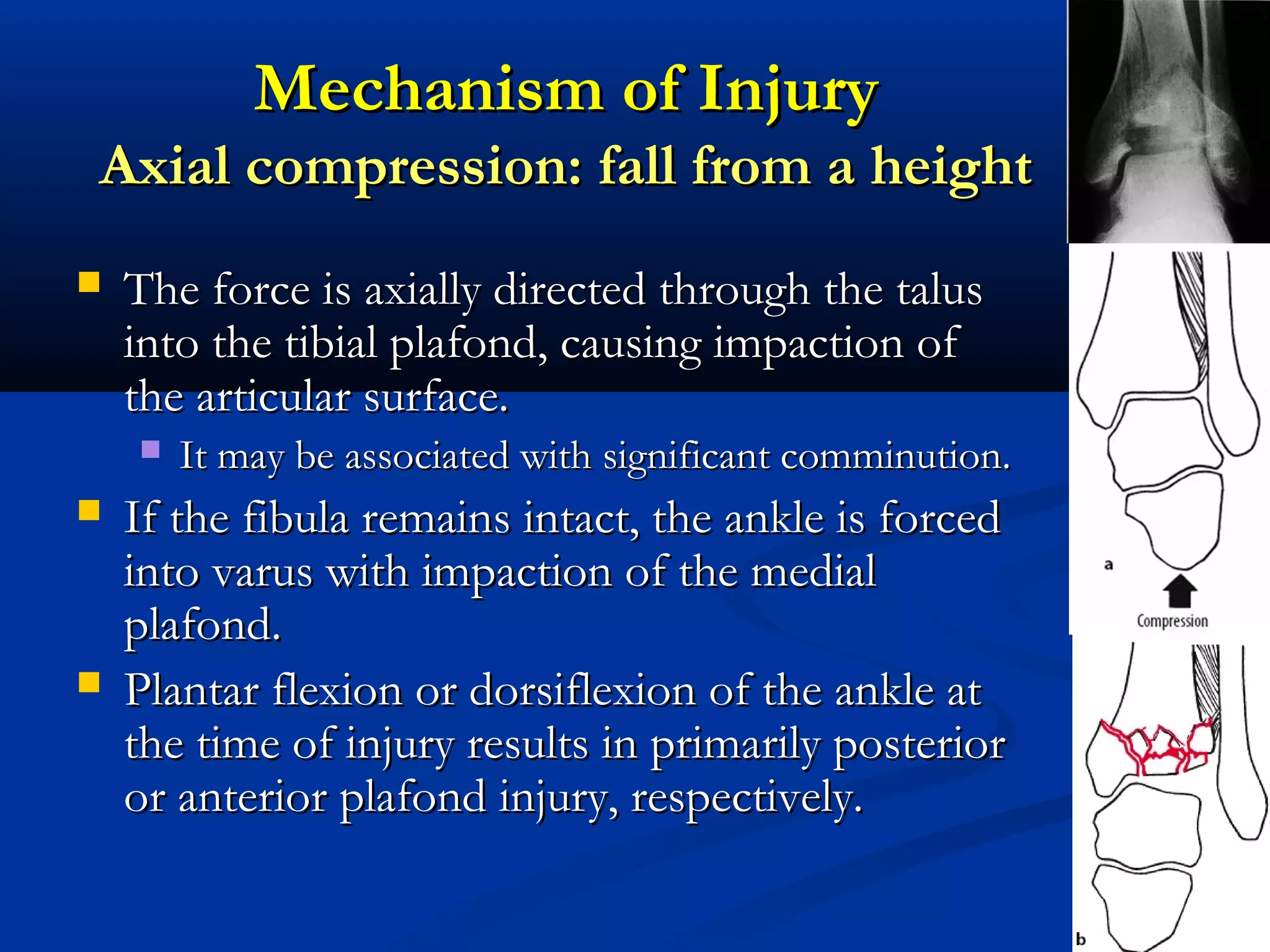 39. tibial plafond (pilon) fractures | PPT