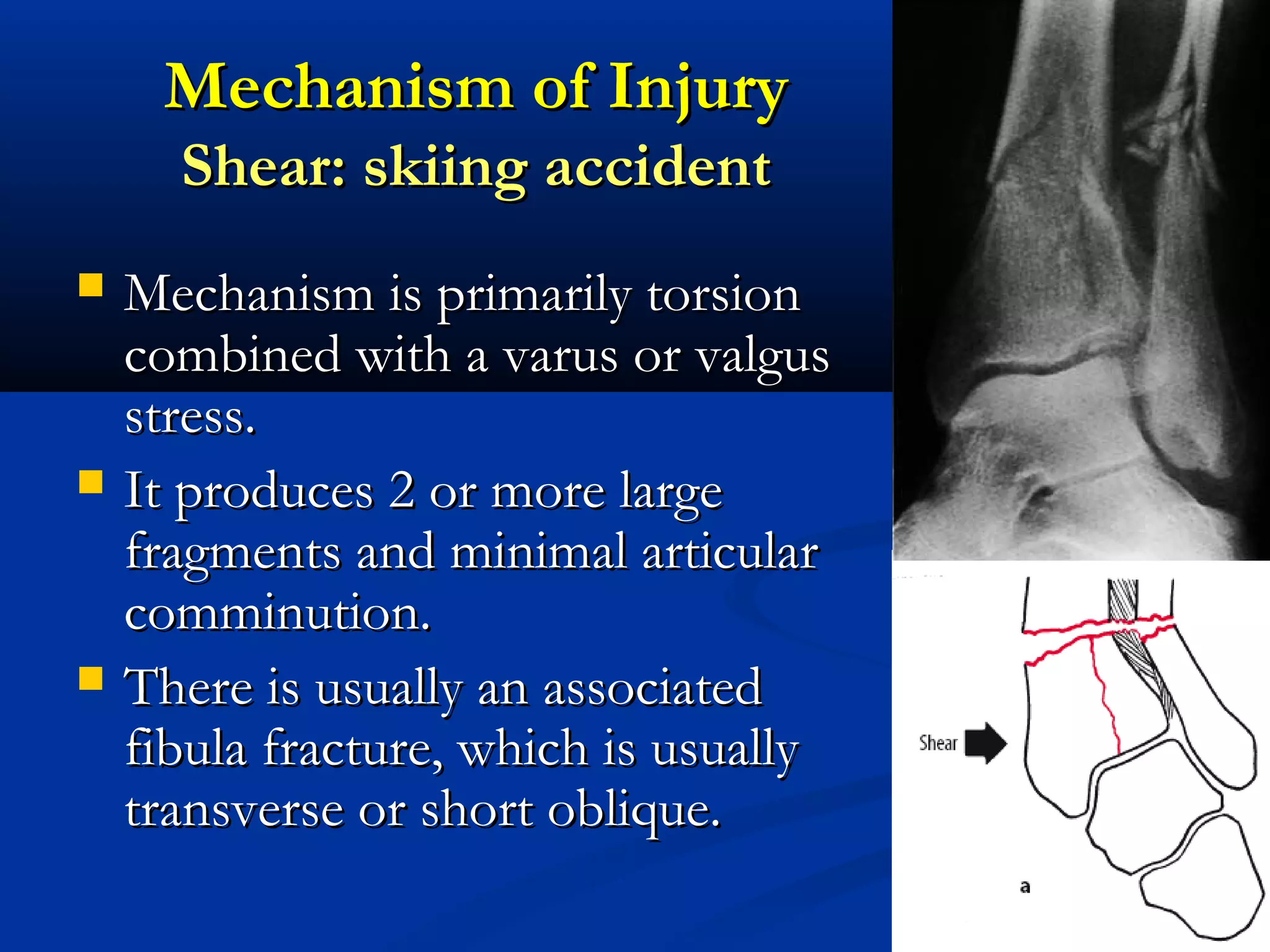 39. tibial plafond (pilon) fractures | PPT