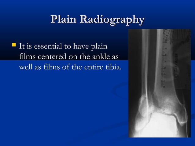 39. tibial plafond (pilon) fractures | PPT | Death, Injury, or Military ...