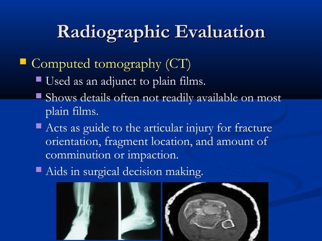 39. tibial plafond (pilon) fractures | PPT | Death, Injury, or Military ...
