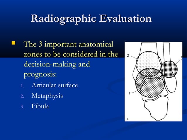 39. tibial plafond (pilon) fractures | PPT | Death, Injury, or Military ...