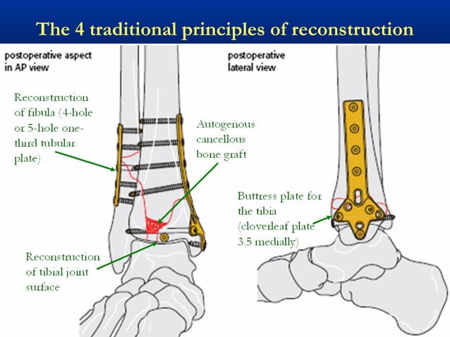 39. tibial plafond (pilon) fractures | PPT | Death, Injury, or Military ...