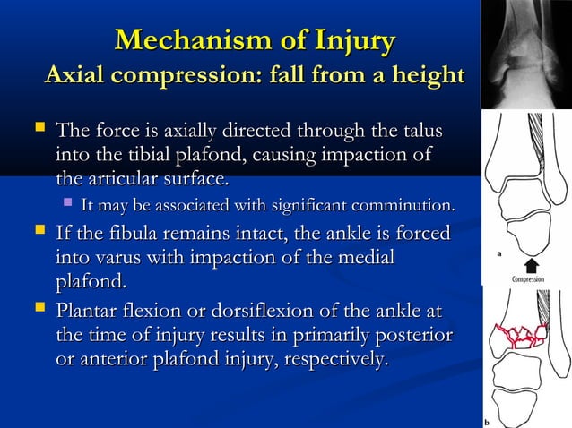 39. tibial plafond (pilon) fractures | PPT | Death, Injury, or Military ...