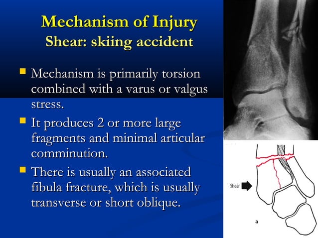 39. tibial plafond (pilon) fractures | PPT | Death, Injury, or Military ...