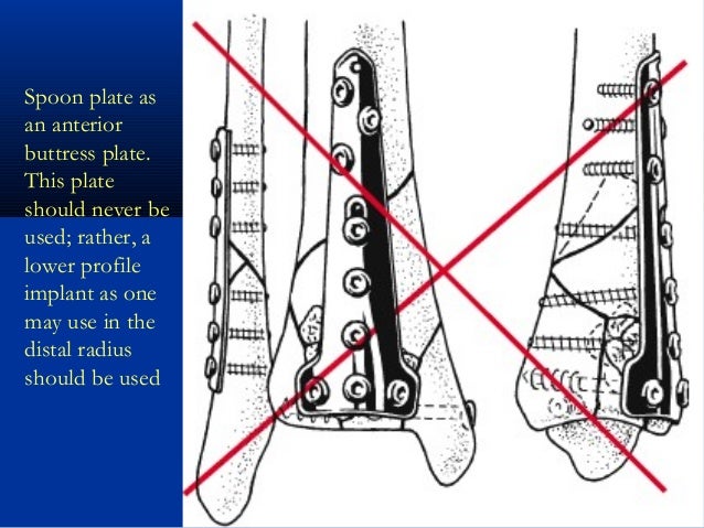 39. tibial plafond (pilon) fractures