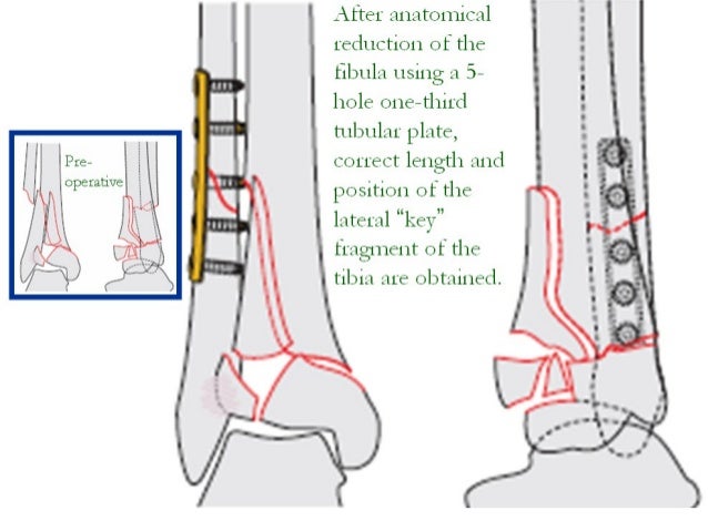 39. tibial plafond (pilon) fractures