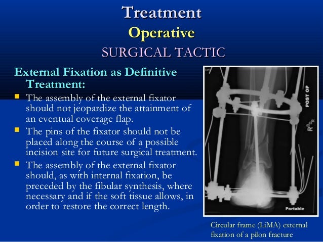 39. tibial plafond (pilon) fractures