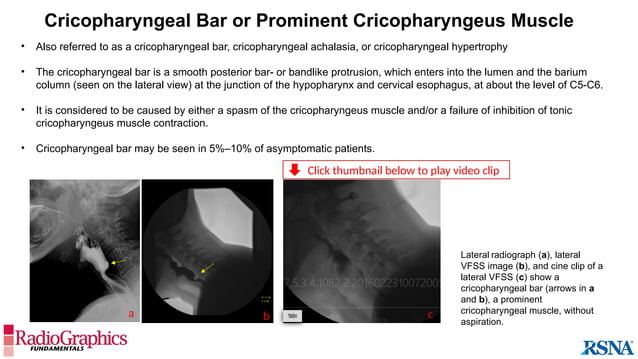 videoflouroscopy radiographics RSNA..... | PPTX