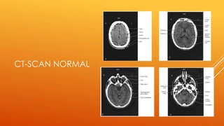 390645310-Cara-Membaca-Ct-scan-Kepala.pdf