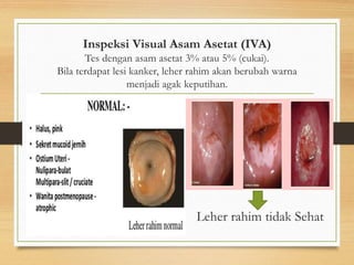 391949245-Penyuluhan-Iva-Test.pptx