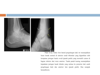 Hemartrosis (Pendarahan sendi) in Englis | PPT