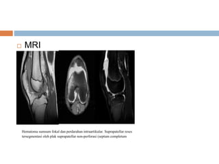 Hemartrosis (Pendarahan sendi) in Englis | PPT