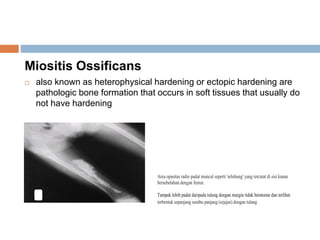 Hemartrosis (Pendarahan sendi) in Englis | PPT