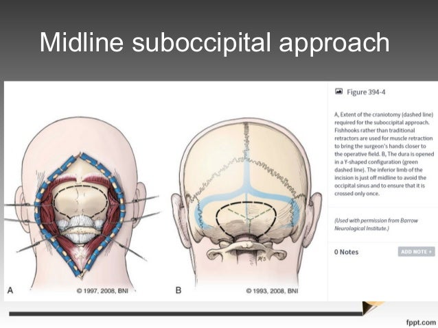 394 Supratentorial and infratentorial cavernous malformation
