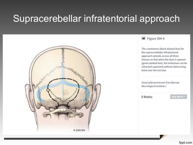 394 Supratentorial and infratentorial cavernous malformation
