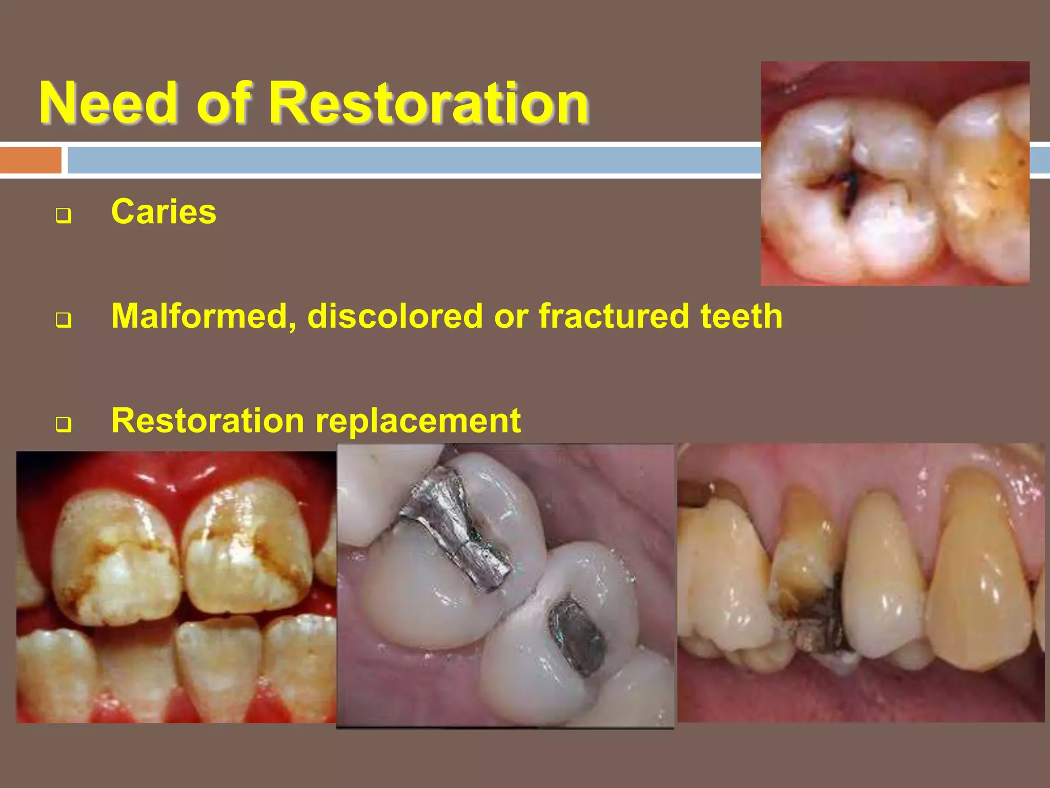 fundamentals of tooth preparation.ppt