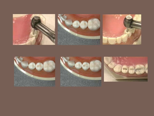 fundamentals of tooth preparation.ppt