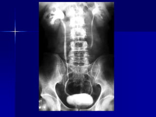 Tract Renal Calculi for Medical and Treatment | PPT