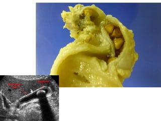 Gallbladder Disease in Children | PPTX