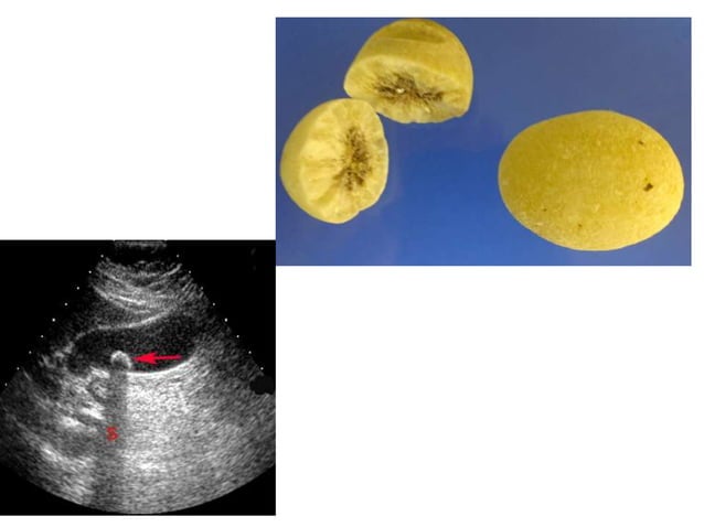 Gallbladder Disease in Children | PPTX | Digestive Disorders | Diseases ...