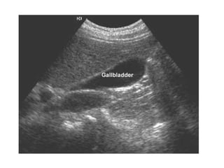 Gallbladder Disease in Children | PPTX