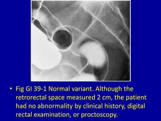 39 enlargement of the retrorectal space | PPTX