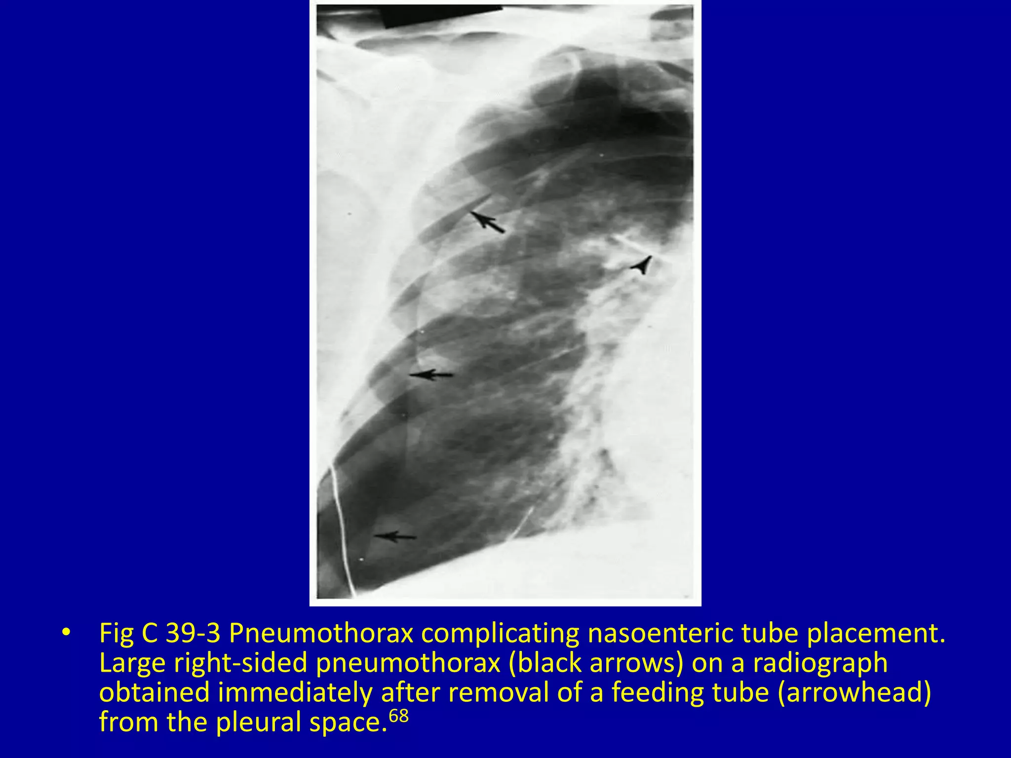 39 pneumothorax | PPTX