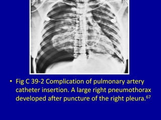 39 pneumothorax | PPTX
