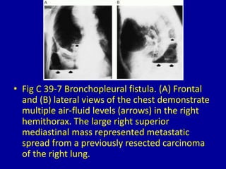 39 pneumothorax | PPTX