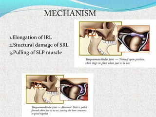 condyle disc-complex_derangement_1 | PPT