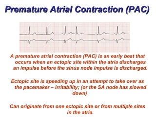Atrial Rhythms - BMH/Tele | PPT