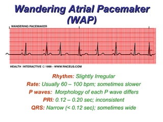 3a atrial rhythms | PPT