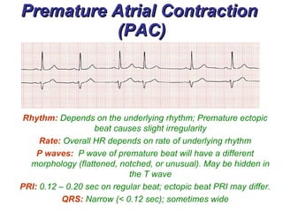 3a atrial rhythms | PPT