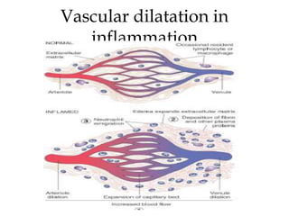 Acute Inflammation.ppt