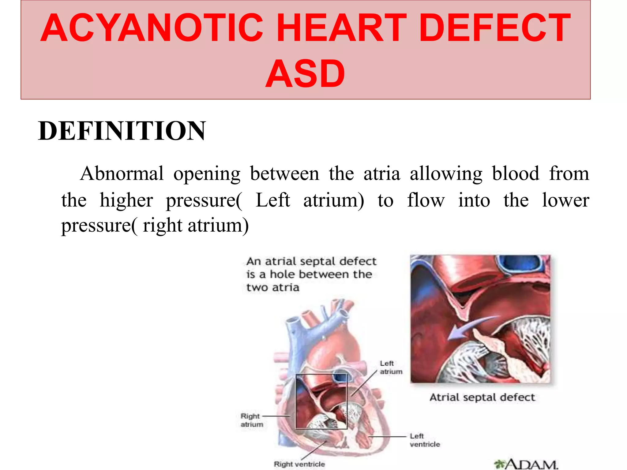CONGENITAL HEART DISEASES | PPT