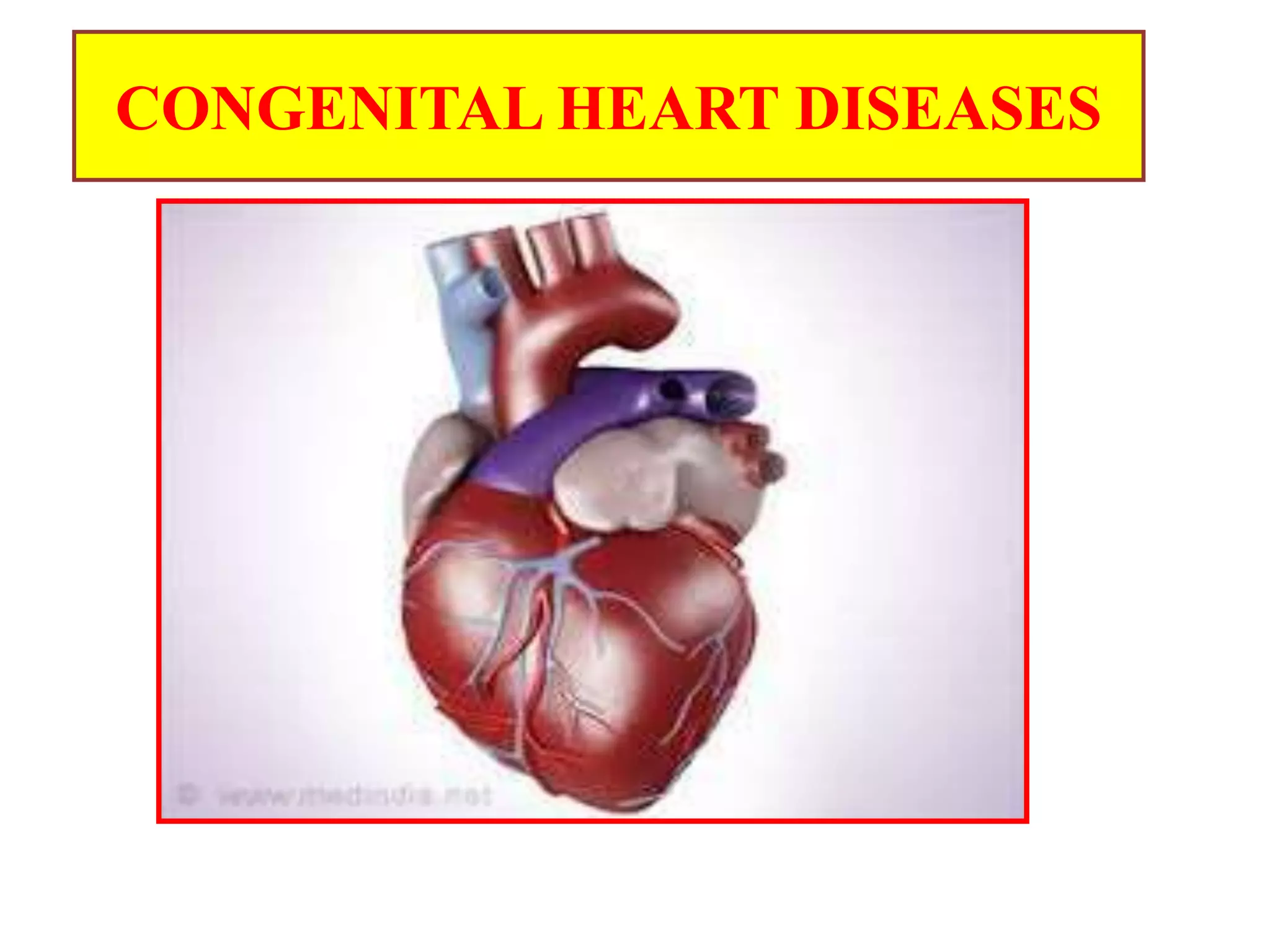 CONGENITAL HEART DISEASES | PPT