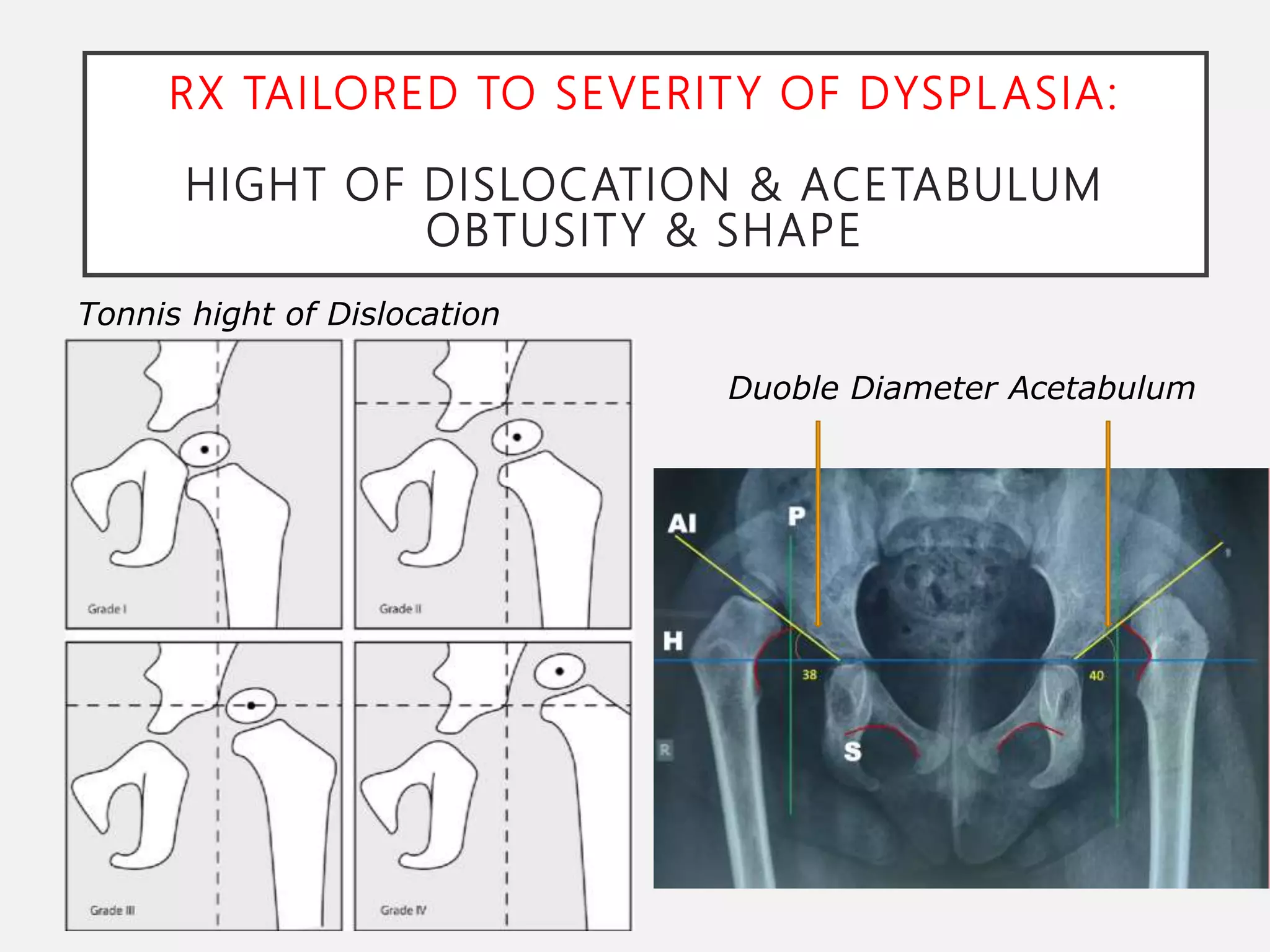 3a ddh open reduction principles & protocols | PPT